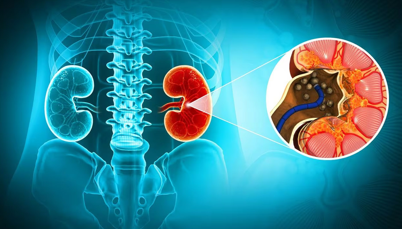 Piedras en el Riñón | Urólogo Dr. Adrián Martínez