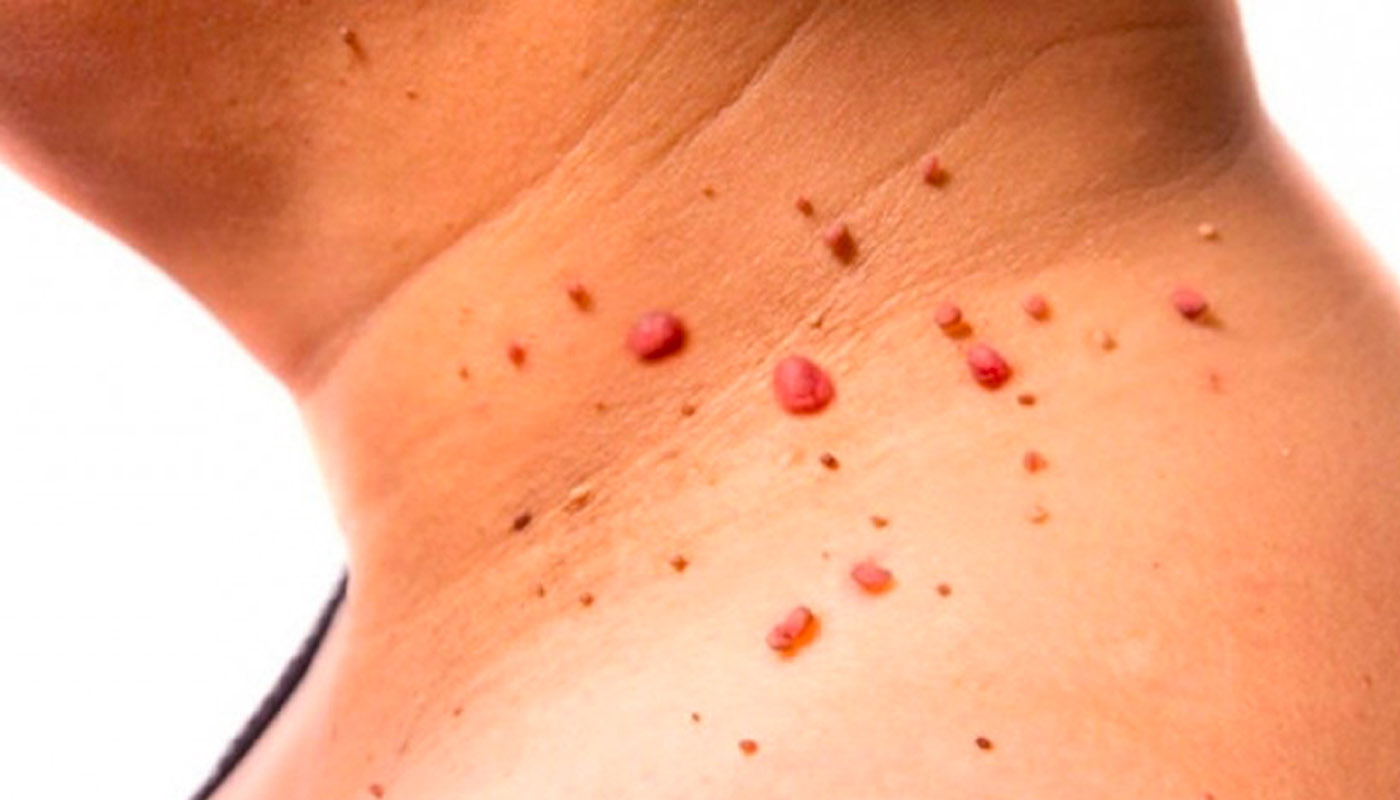 Virus del Papiloma Humano (VPH) | Urólogo Dr. Adrián Martínez